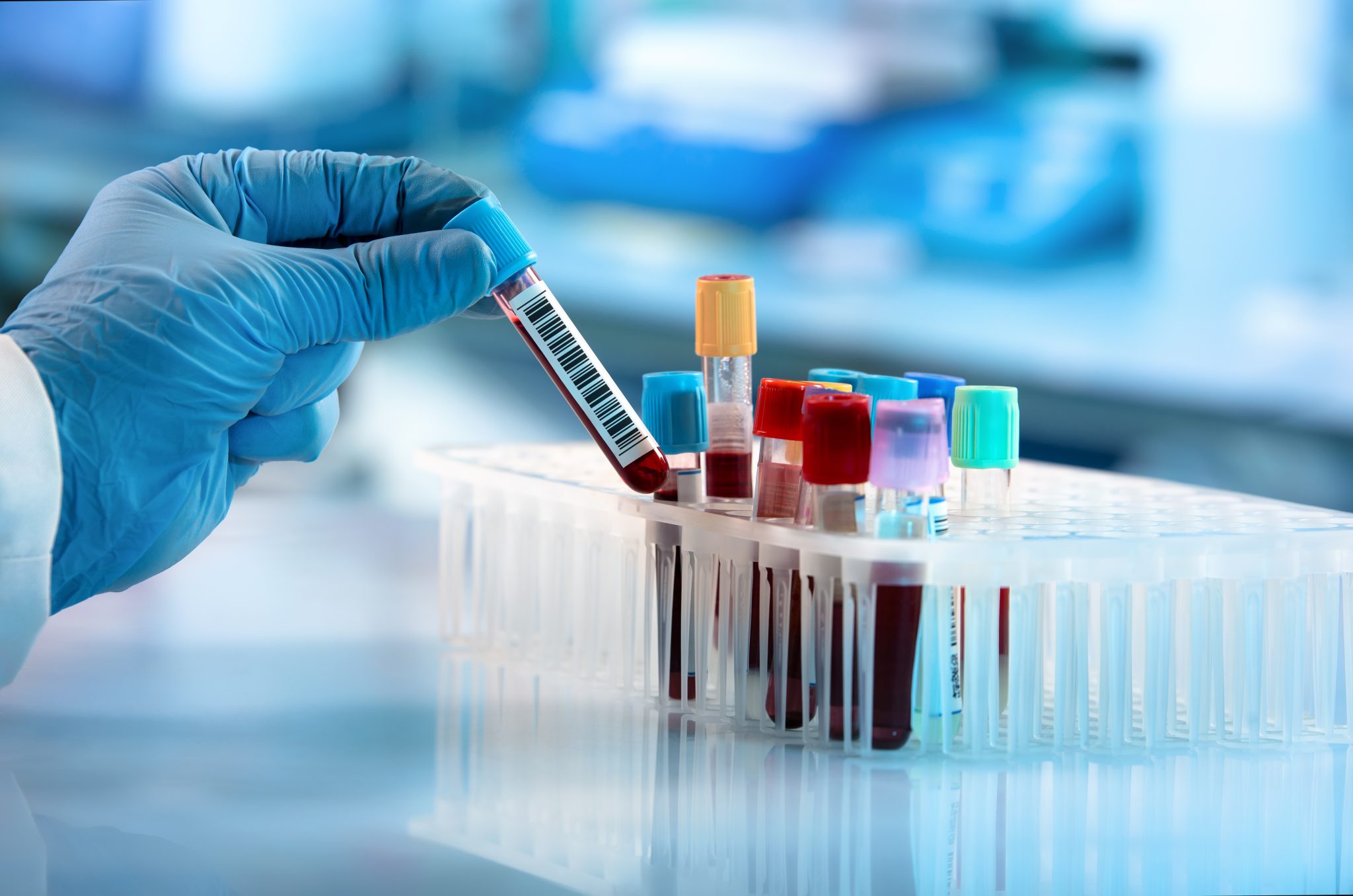 Screening Blood Test Packages in Singapore